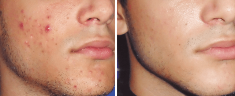 Acnelan - SkinRX Aesthetic Clinic PTY (LTD)