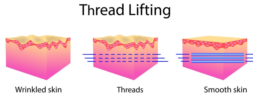 Thesera Thread Lift - SkinRX Aesthetic Clinic PTY (LTD)