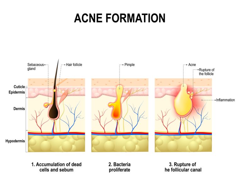 Acne – Skin Conditions - SkinRX Aesthetic Clinic PTY (LTD)
