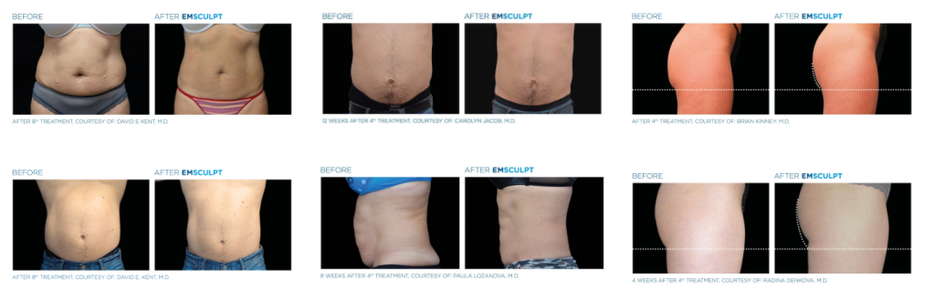 EMSCULPT Body Toning & Sculpting - SkinRX Aesthetic Clinic PTY (LTD)