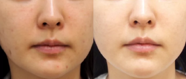 Lemonbottle Skin Booster - SkinRX Aesthetic Clinic PTY (LTD)