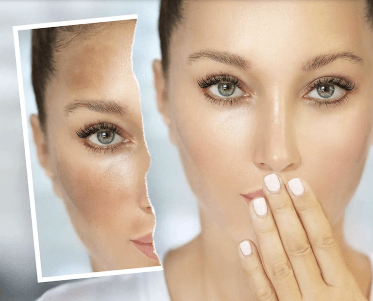 MeLine Skin Peel - SkinRX Aesthetic Clinic PTY (LTD)
